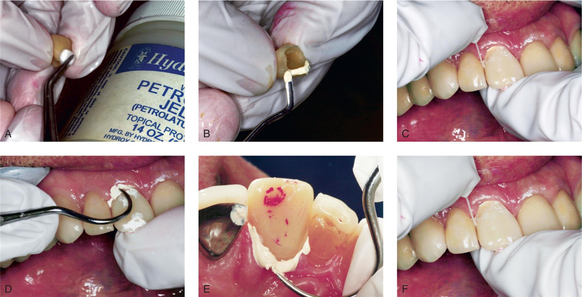 15: Interim Fixed Restorations