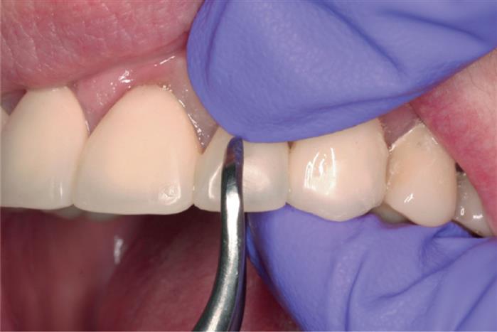 15: Interim Fixed Restorations