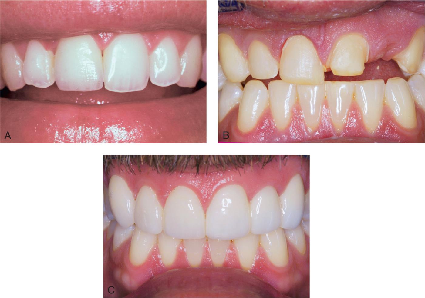 15: Interim Fixed Restorations
