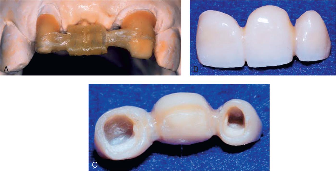 15: Interim Fixed Restorations
