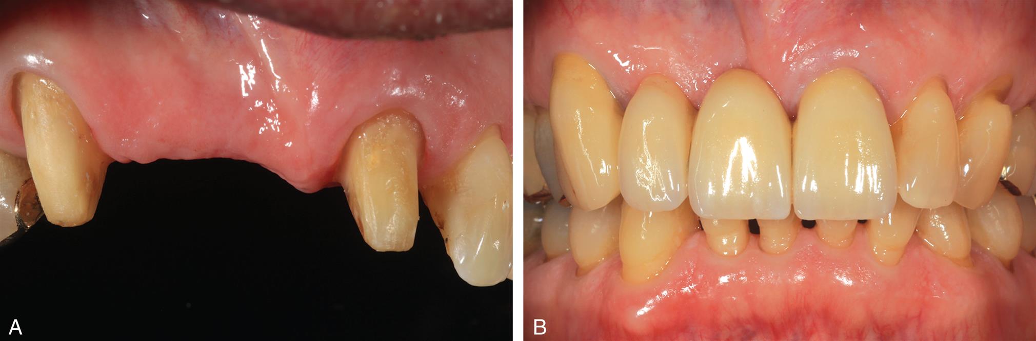 26: Resin-Bonded Fixed Partial Dentures
