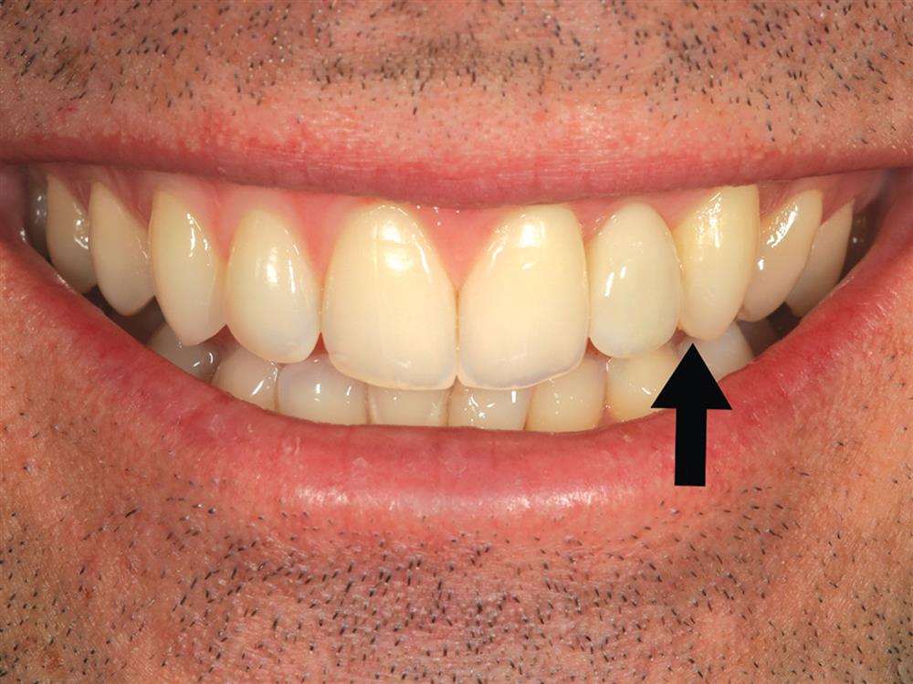 26: Resin-Bonded Fixed Partial Dentures