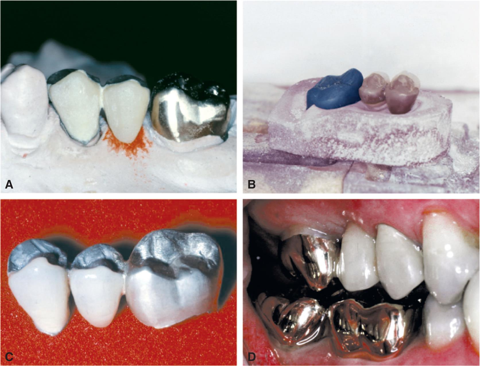 27: Connectors for Fixed Partial Dentures