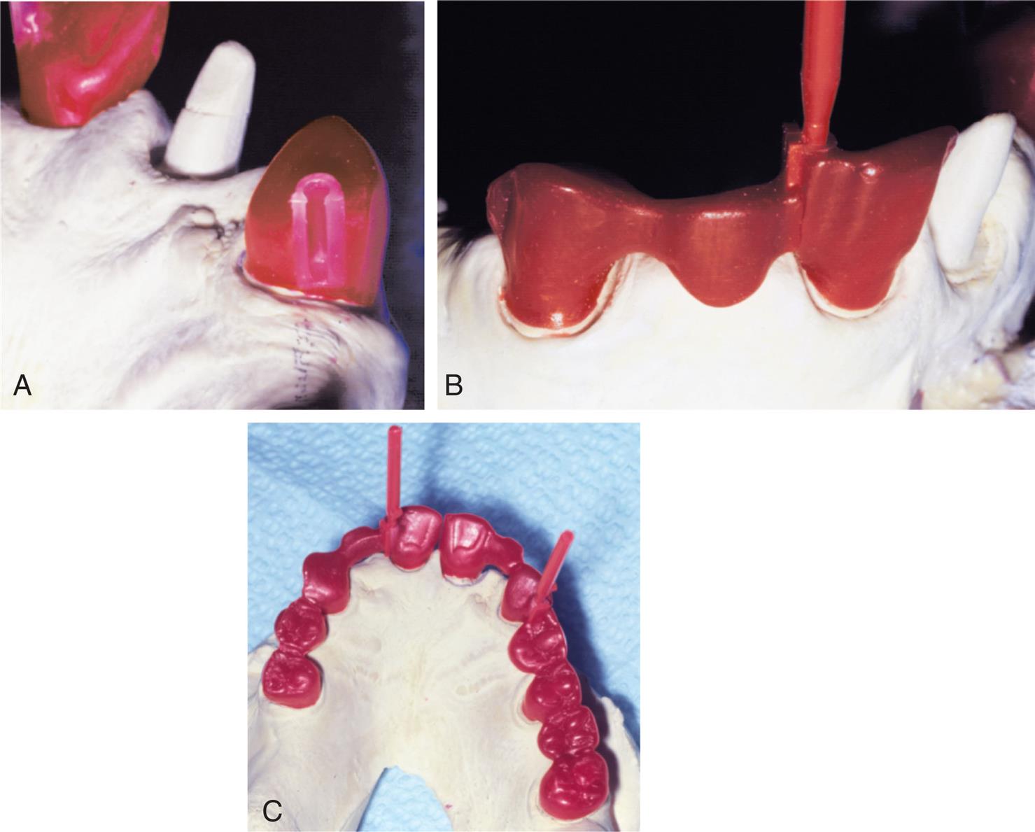 27: Connectors for Fixed Partial Dentures