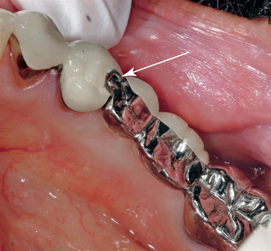 27: Connectors for Fixed Partial Dentures
