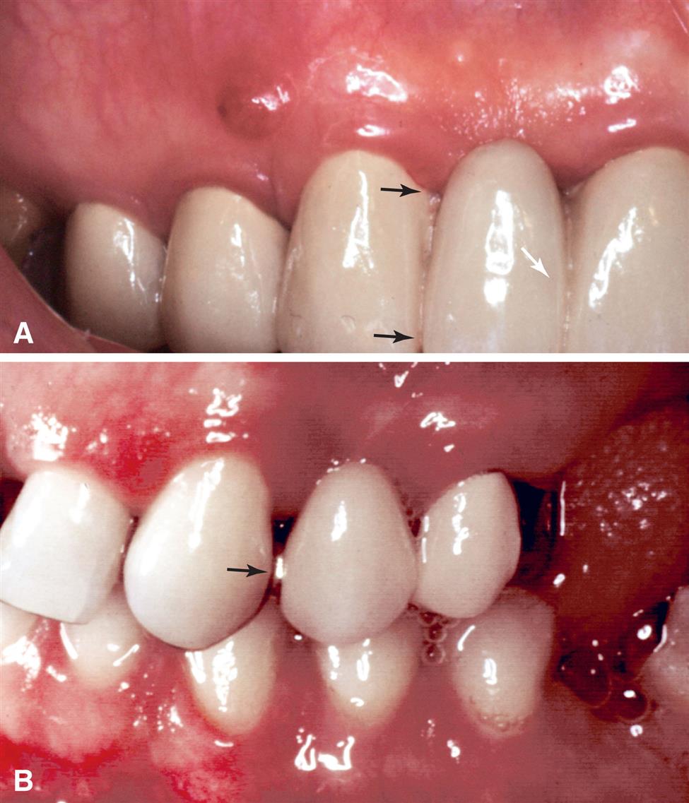27: Connectors for Fixed Partial Dentures