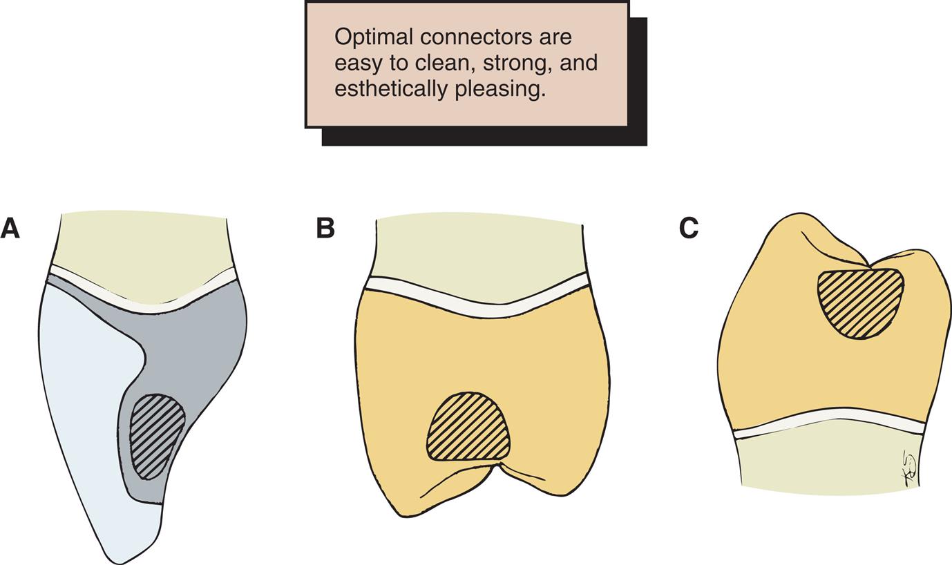 27: Connectors for Fixed Partial Dentures