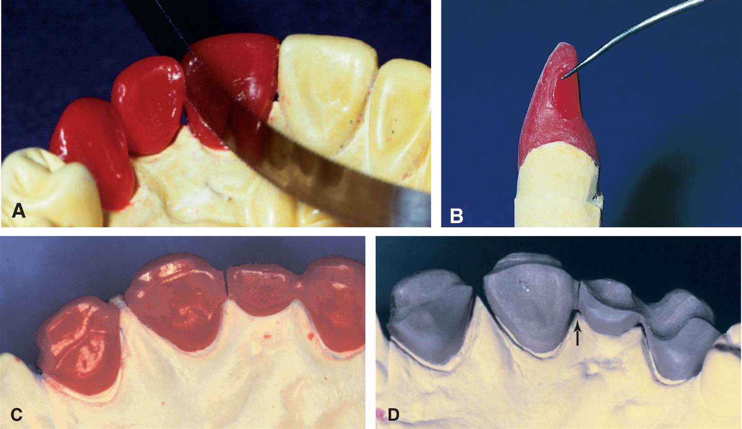 27: Connectors for Fixed Partial Dentures