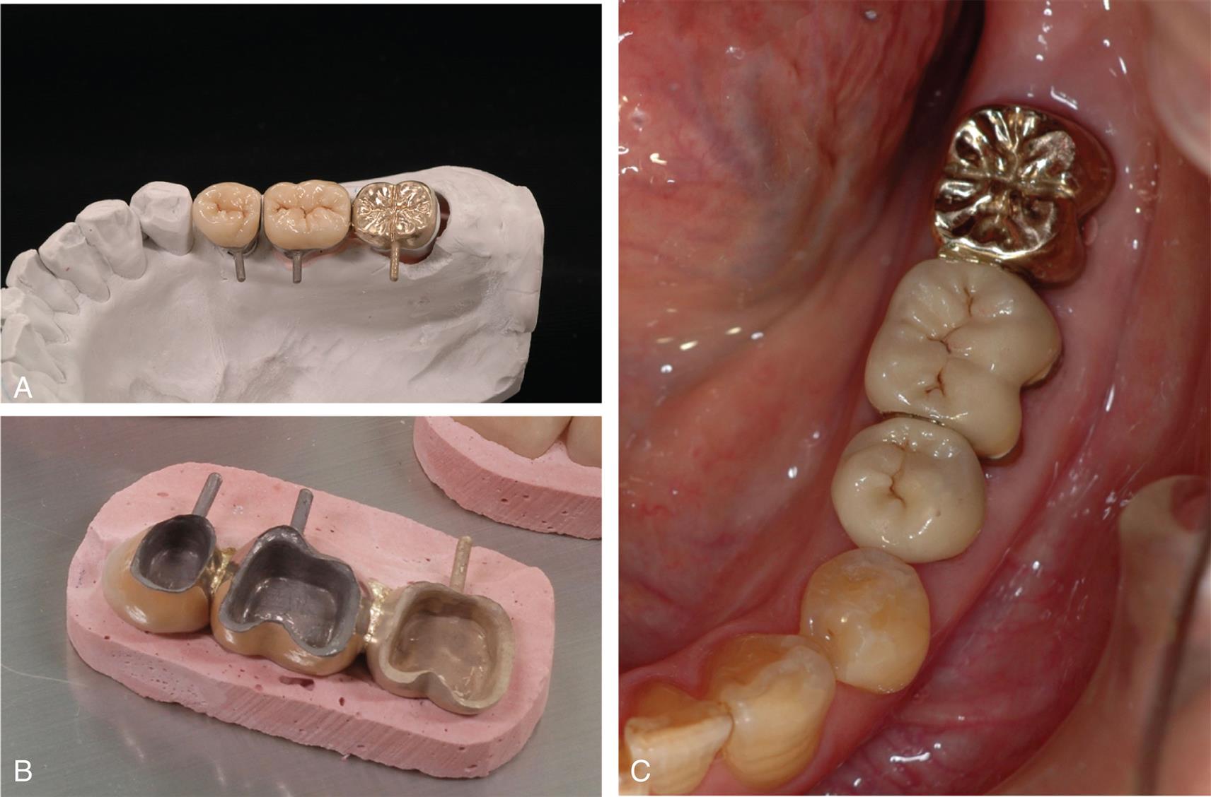 27: Connectors for Fixed Partial Dentures