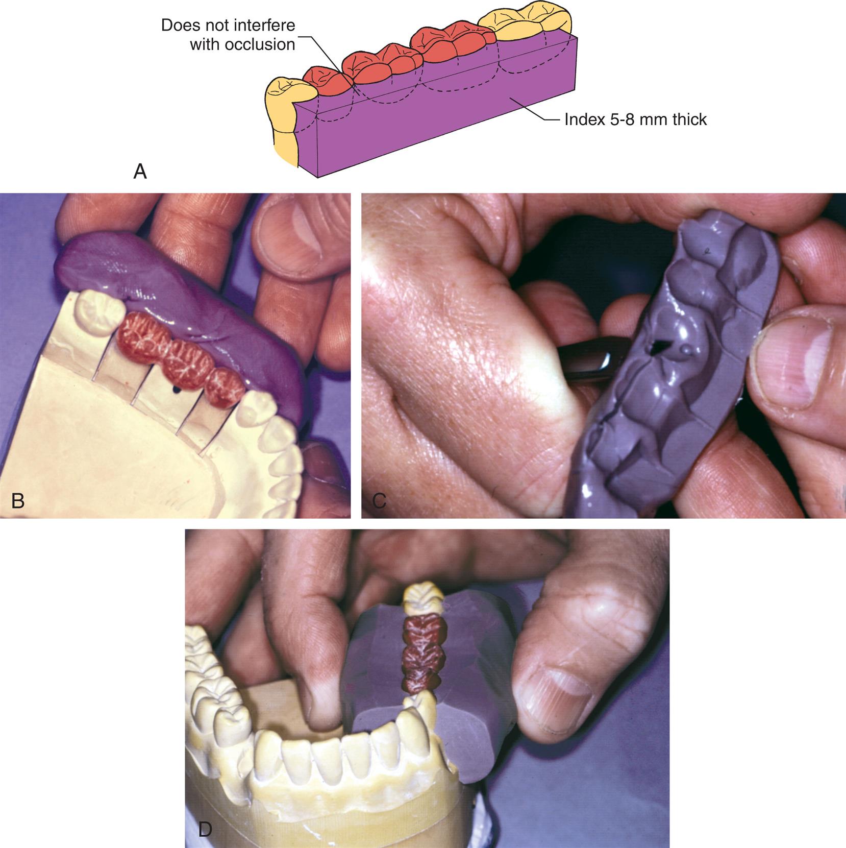 27: Connectors for Fixed Partial Dentures