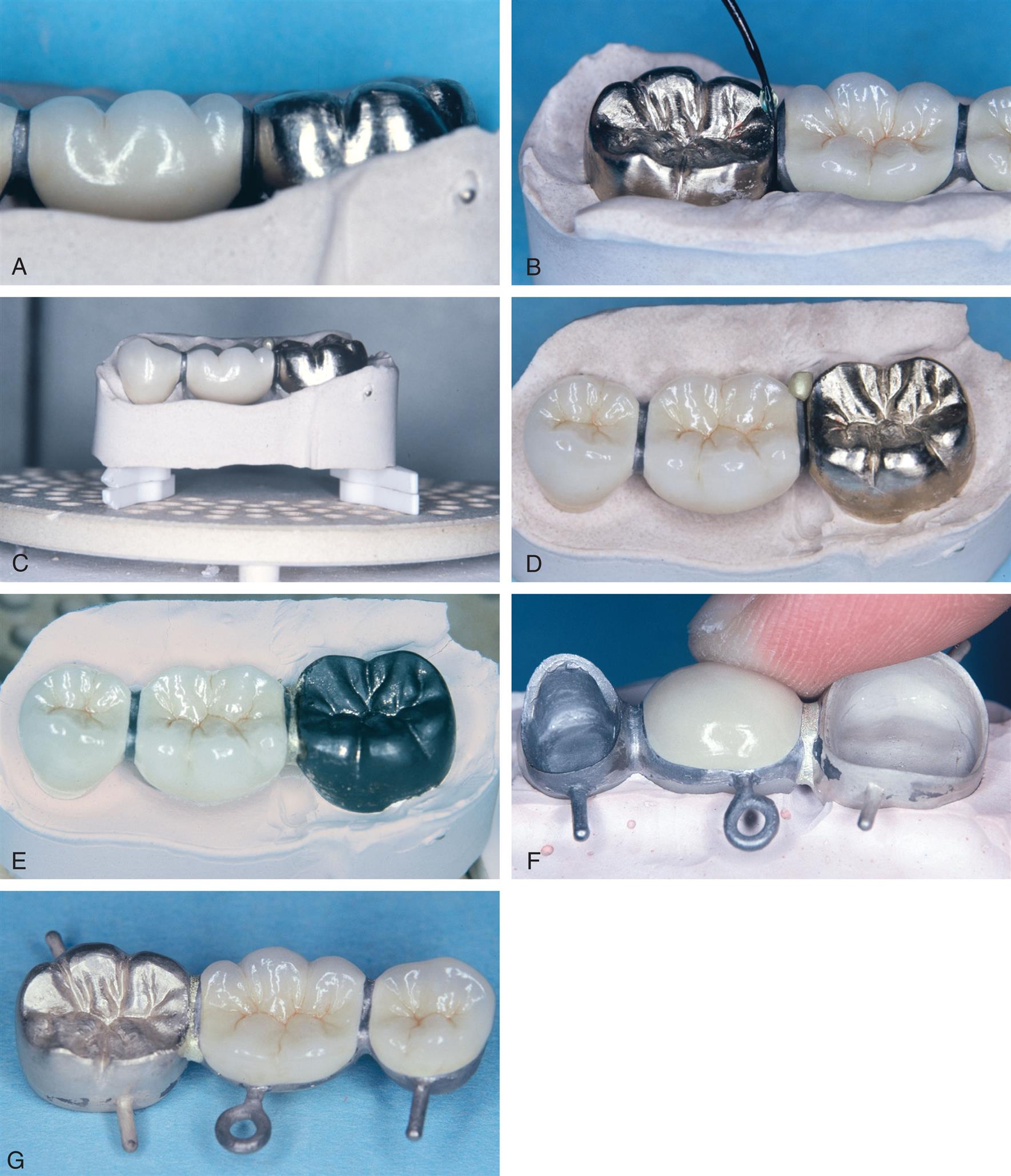 27: Connectors for Fixed Partial Dentures