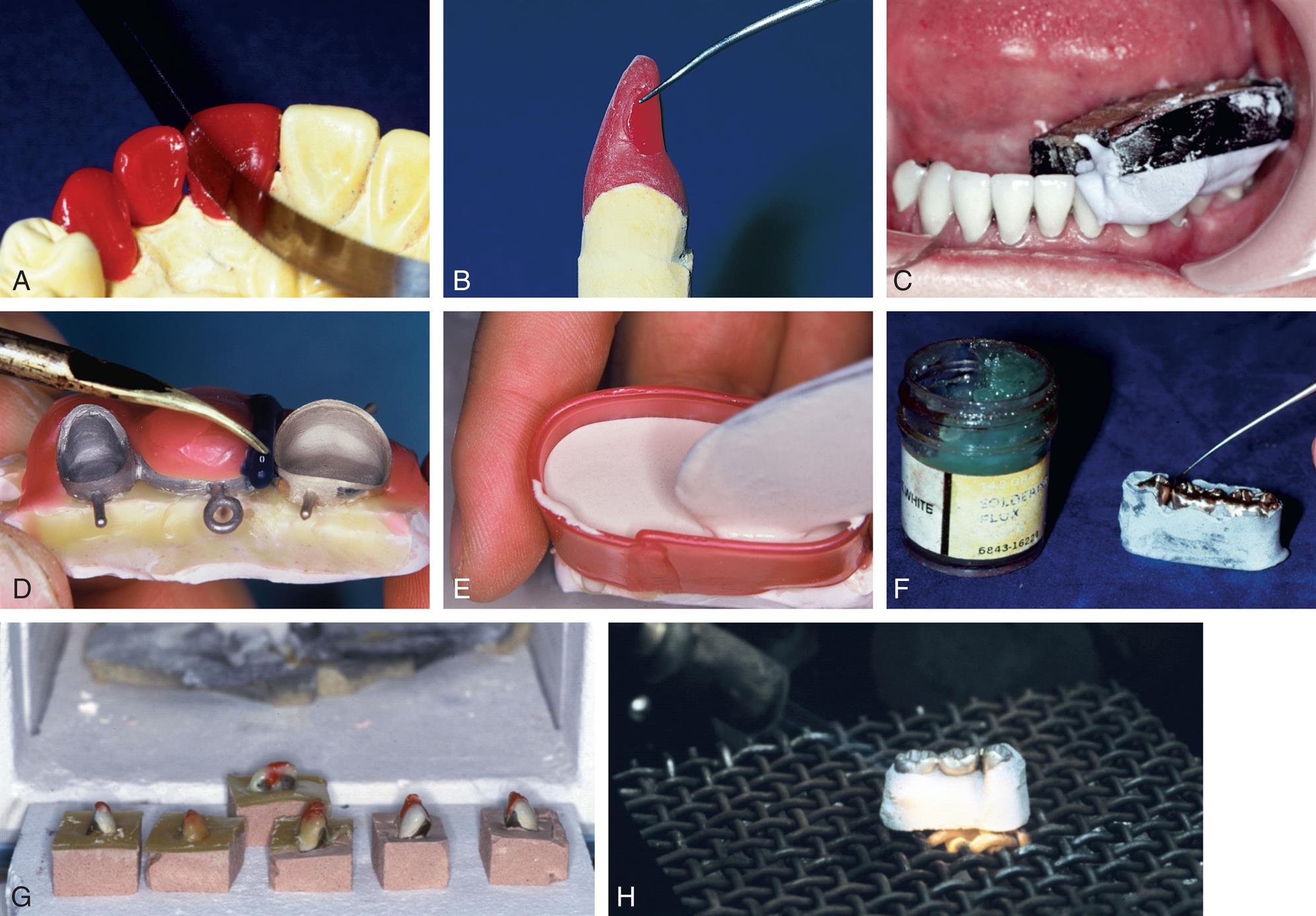 27: Connectors for Fixed Partial Dentures