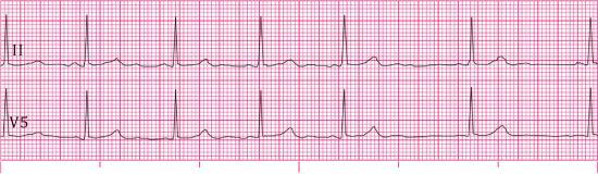 Sinus mechanisms