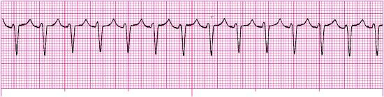 Junctional rhythms
