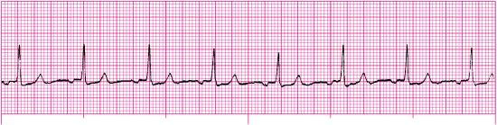 Junctional rhythms
