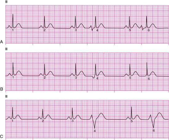 Ventricular rhythms
