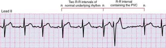 Ventricular rhythms