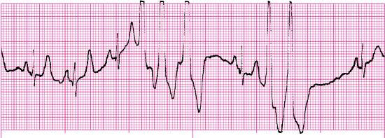 Ventricular rhythms