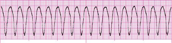 Ventricular rhythms