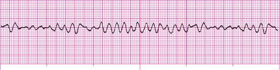 Ventricular rhythms