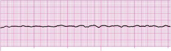 Ventricular rhythms