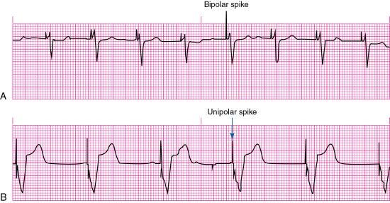 Pacemaker rhythms