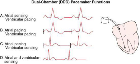 Pacemaker rhythms
