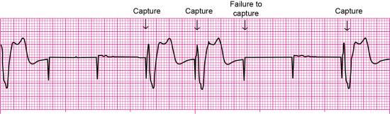 Pacemaker rhythms