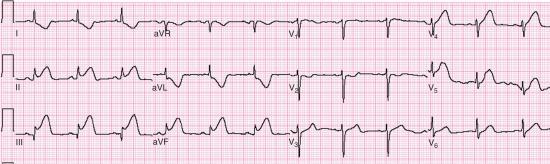 Introduction to the 12-lead ECG
