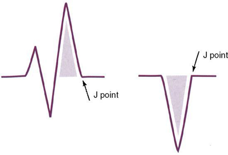 Introduction to the 12-lead ECG
