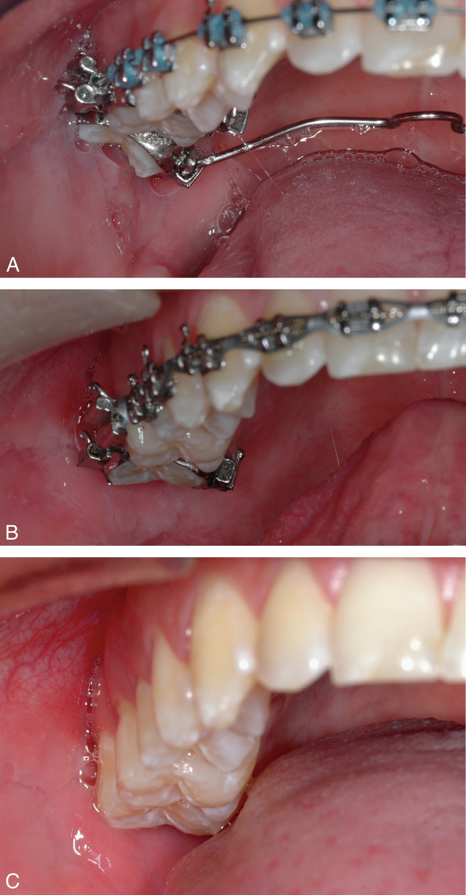 19: Contemporary Straight Wire Biomechanics