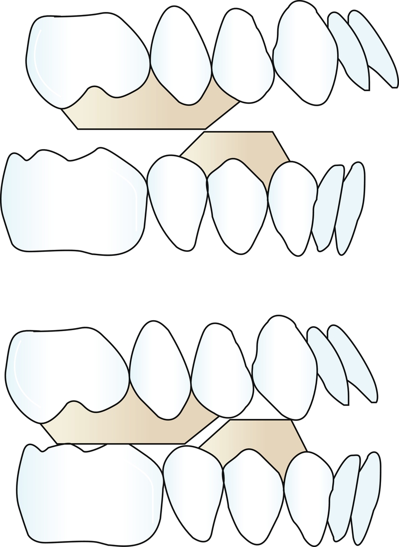 39: Functional Appliances