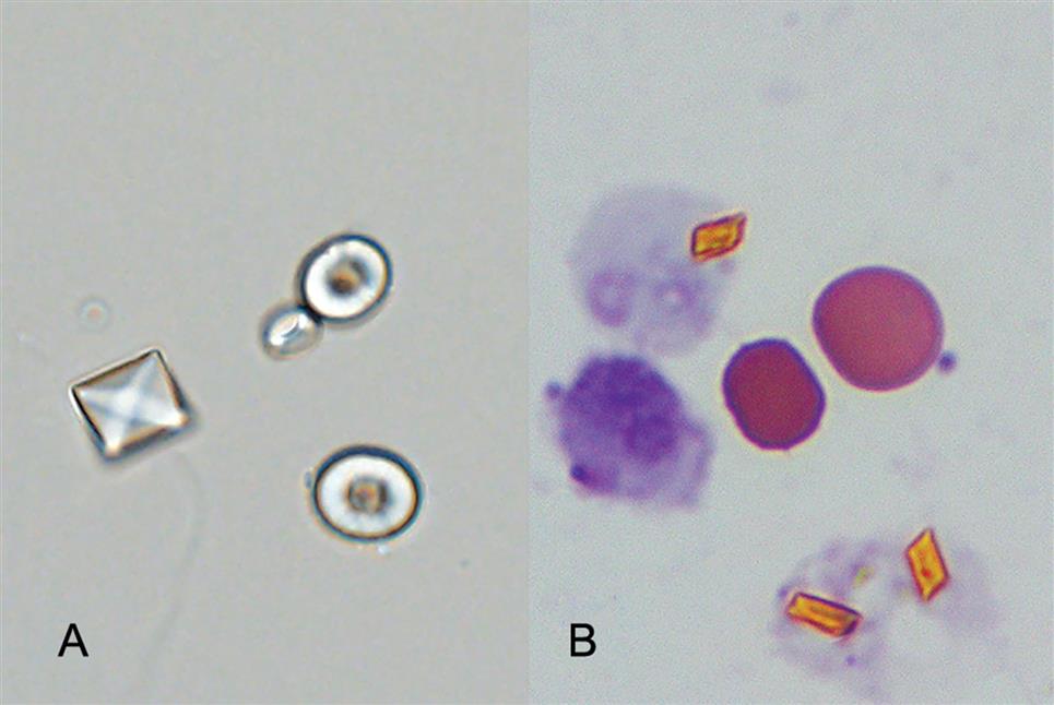 11: Synovial Fluid Analysis