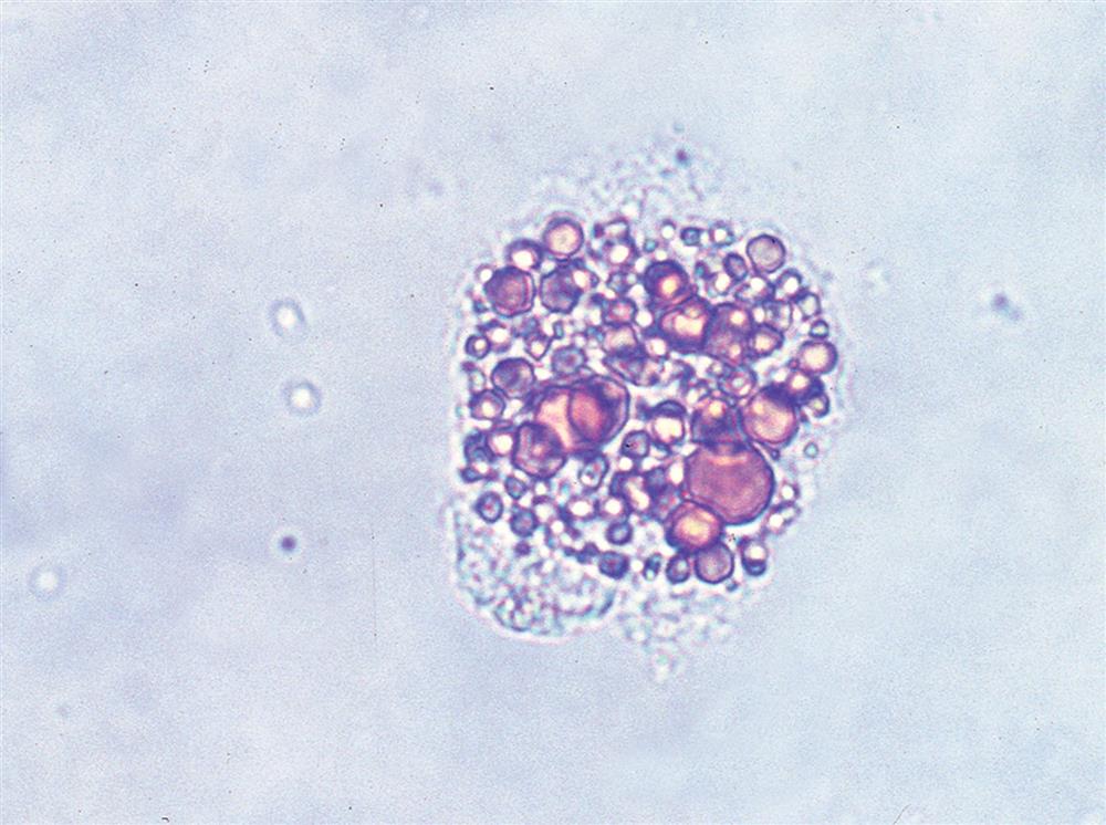 7: Routine Urinalysis–the Microscopic Exam of Urine Sediment