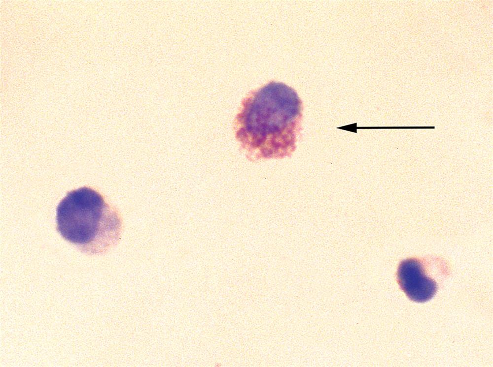 7: Routine Urinalysis–the Microscopic Exam of Urine Sediment
