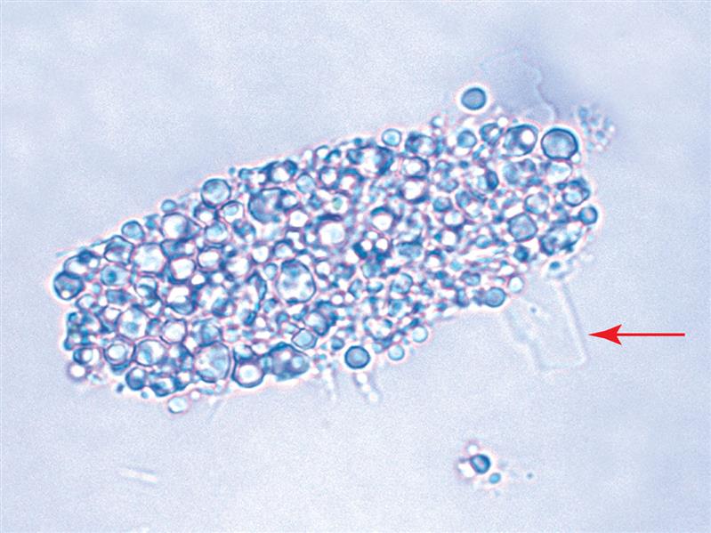 7: Routine Urinalysis–the Microscopic Exam of Urine Sediment