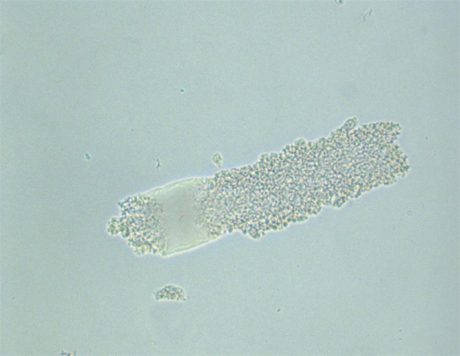 7: Routine Urinalysis–the Microscopic Exam of Urine Sediment