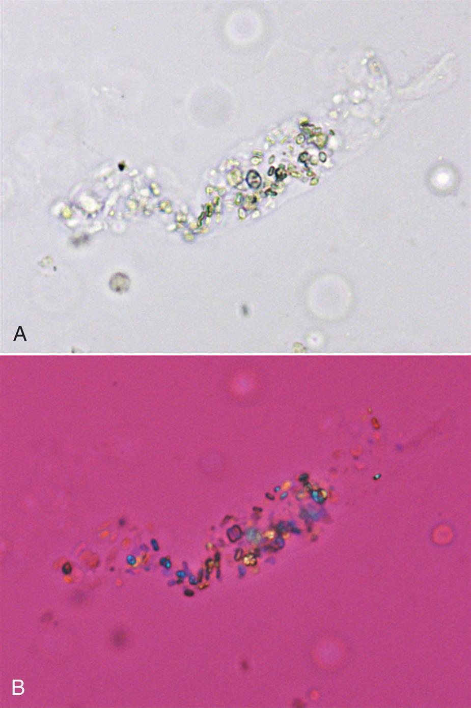 7: Routine Urinalysis–the Microscopic Exam of Urine Sediment