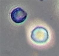 7: Routine Urinalysis–the Microscopic Exam of Urine Sediment