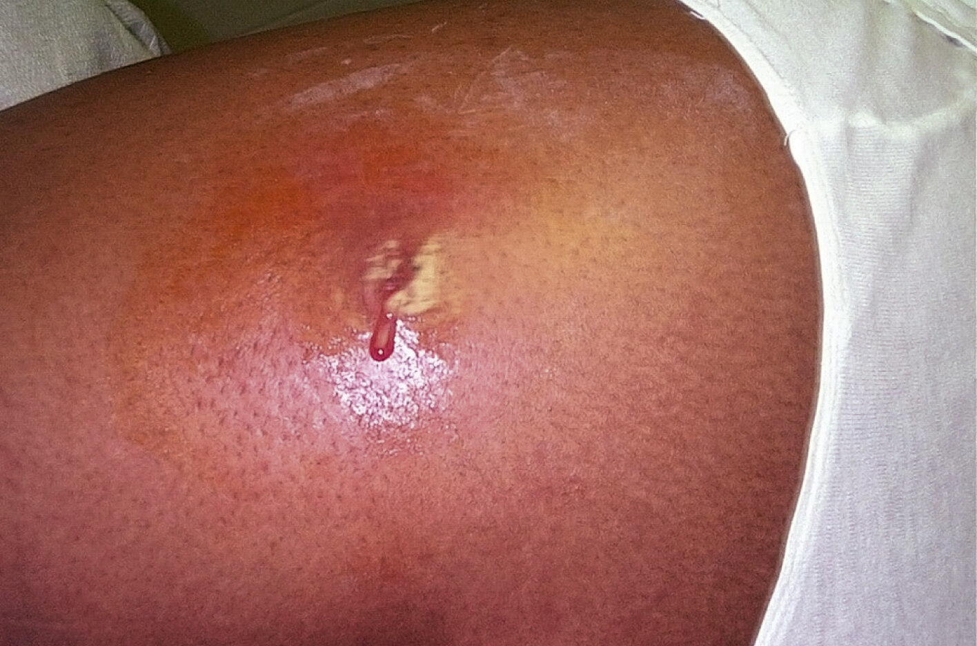Asepsis and Infection Control