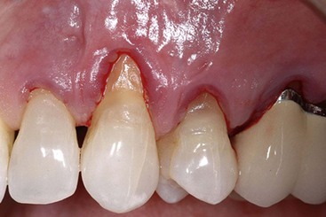 Carranza’s Clinical Periodontology