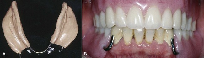 McCracken’s Removable Partial Prosthodontics
