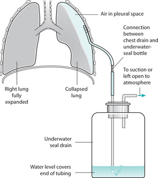 Chest Drainage: Underwater Seal or Chest Drainage System
