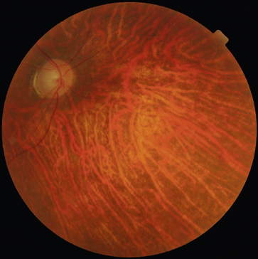 Fundoscopy Made Easy