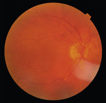 Fundoscopy Made Easy