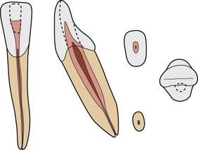Pulp space anatomy and access cavities