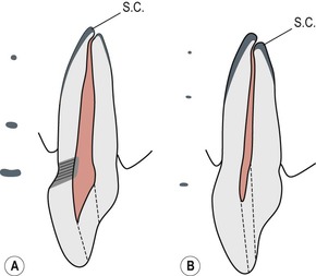 Pulp space anatomy and access cavities
