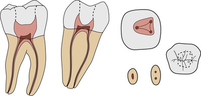 Pulp space anatomy and access cavities