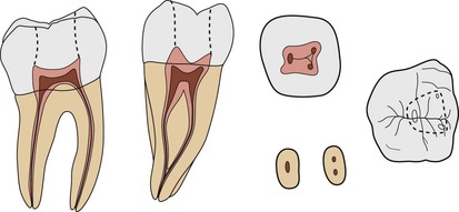 Pulp space anatomy and access cavities