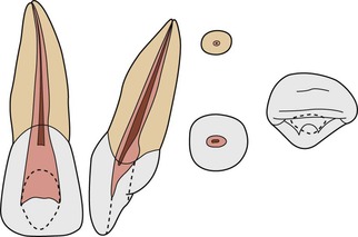 Pulp space anatomy and access cavities